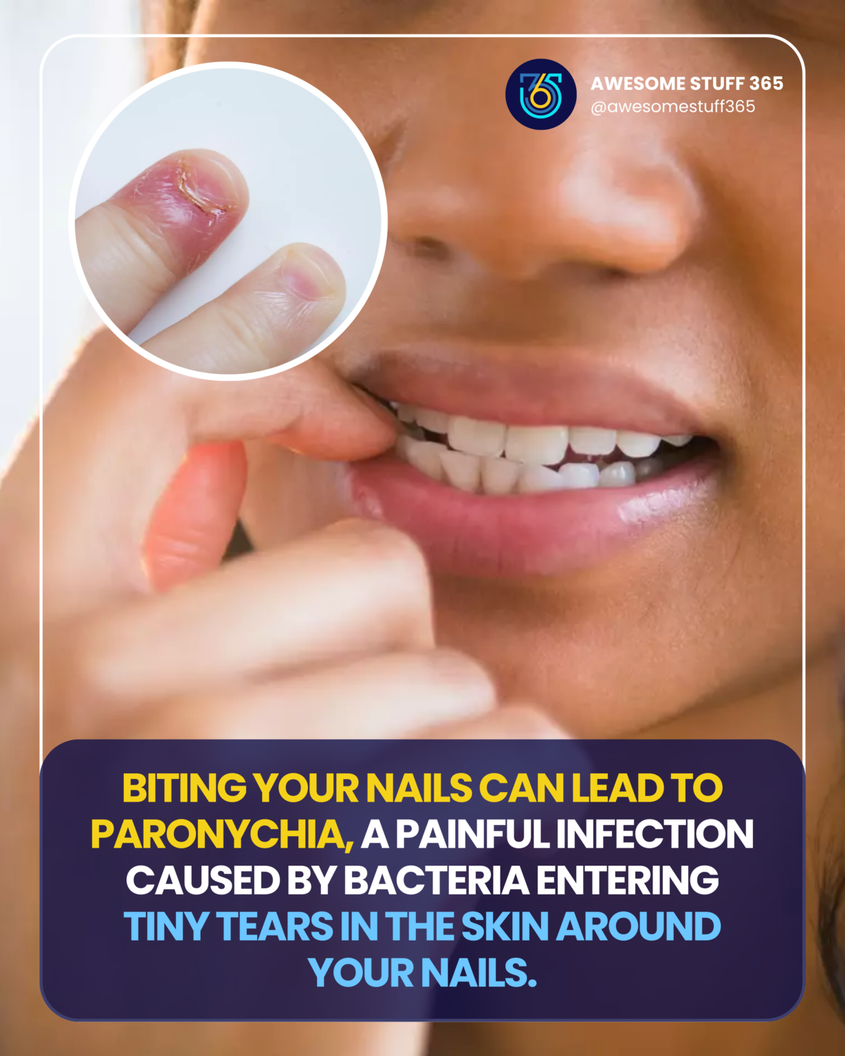 Biting Your Nails: A Habit That Could Lead to Painful Infections